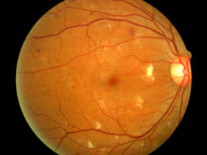 Diabetes retinal screening - barryandsargent.co.nz